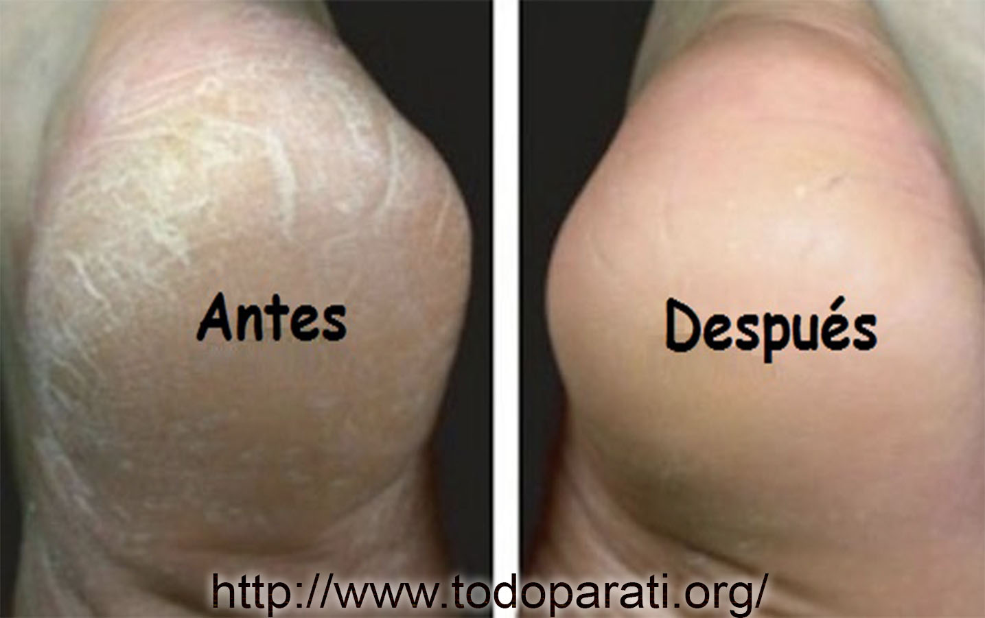 Truco simple y natural para pies secos y agrietados | Todo para ti